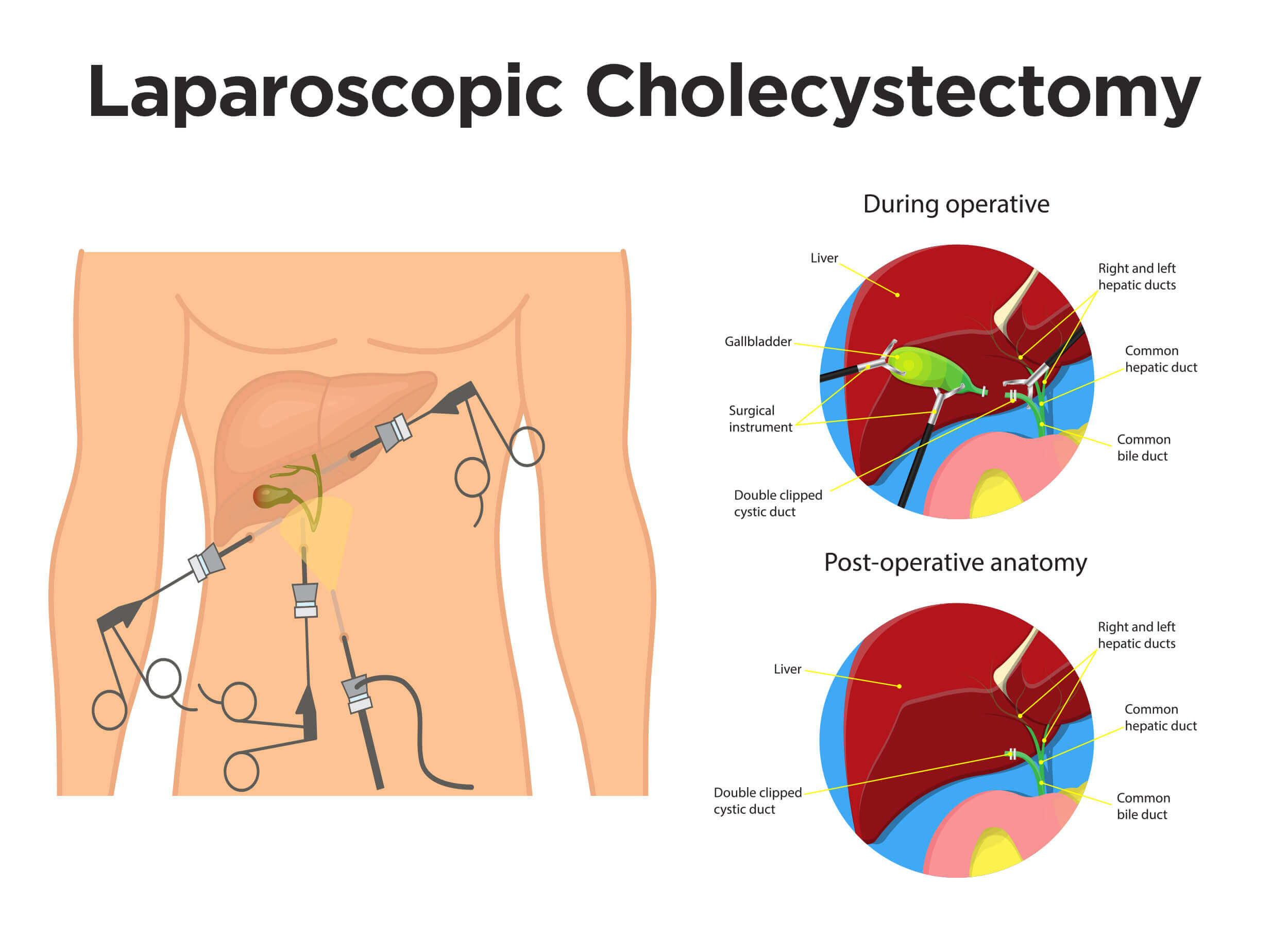 Cholecystectomy Gallbladder Removal Laparoscopic Surgery JS Wong Clinic Cholecystectomy Gallbladder Removal Laparoscopic Surgery JS Wong Clinic